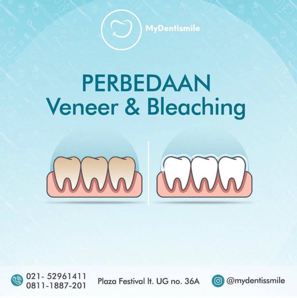 VENEER ATAU BLEACHING? APA BEDANYA? | MyDentismile Dental Clinic